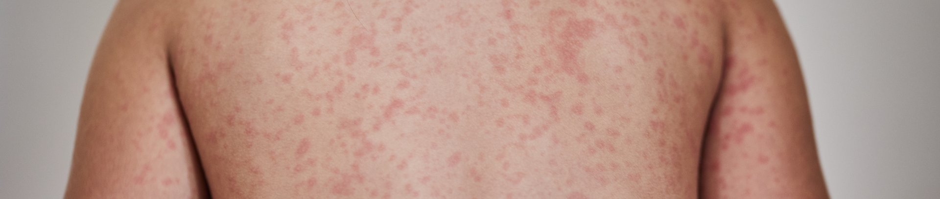 Roseola | Parent Survival Guide | ParentMD